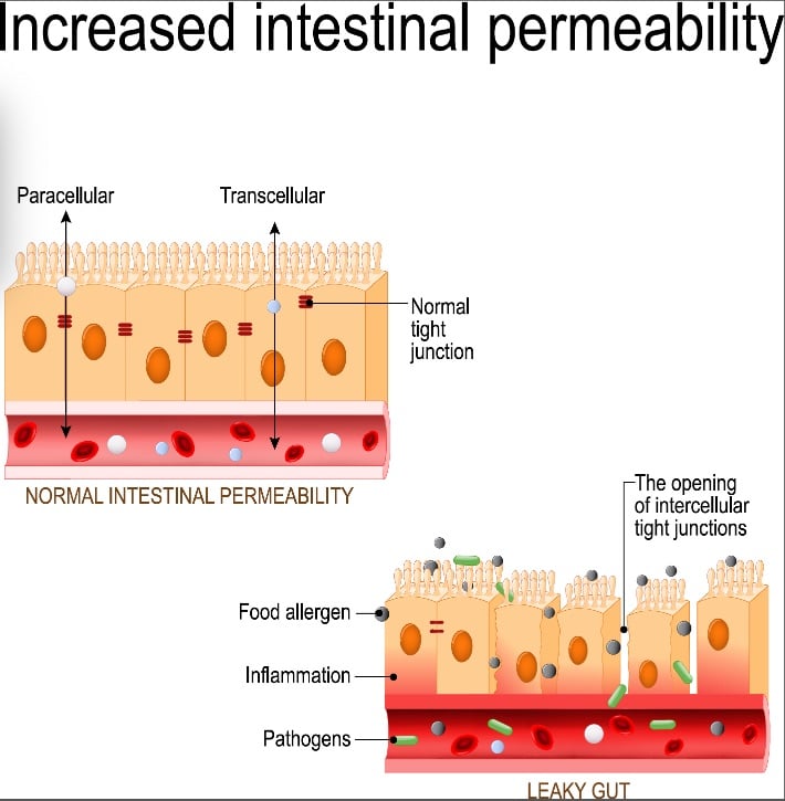 Leaky Gut Syndrome | Nutrition Counseling